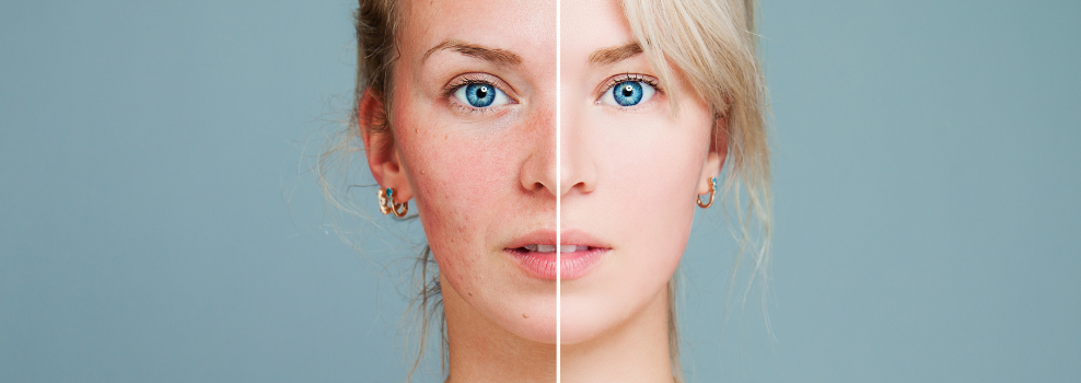 Huidproblemen & Stress | Chi Natural Life Blog - Chi Natural Life